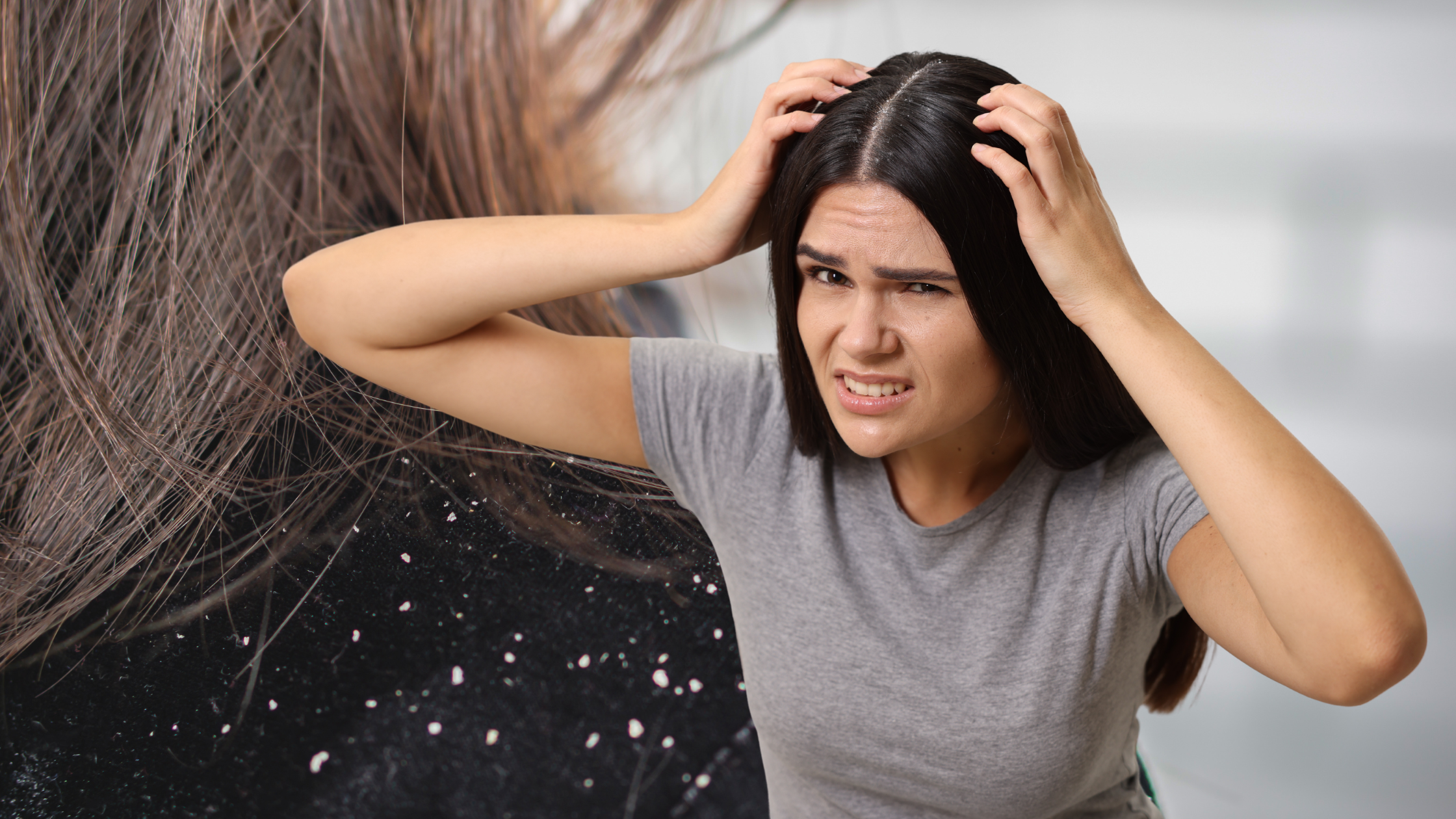 How To Get Rid Of Dandruff Through Ayurveda – Kiyo Beauty India